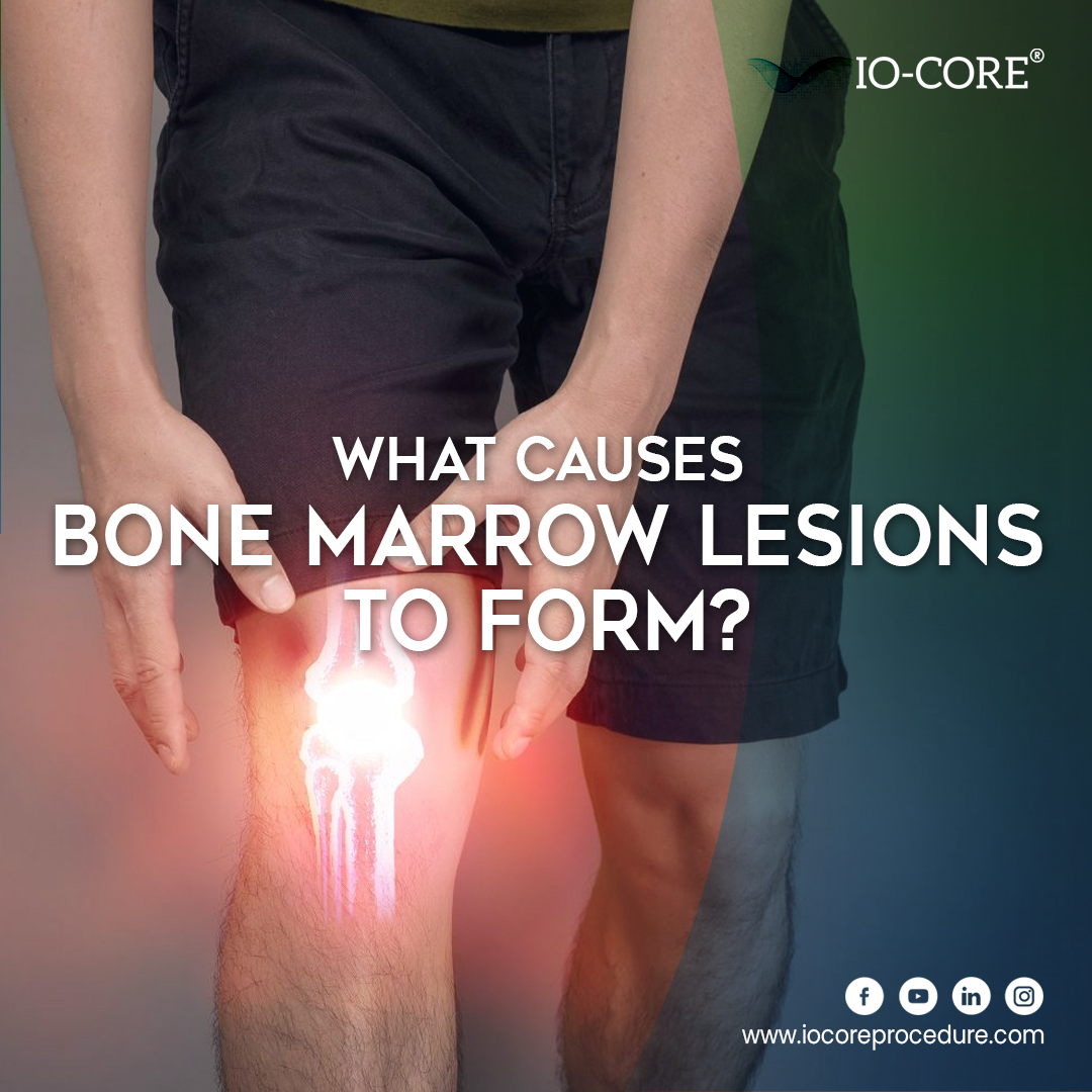 What Causes Bone Marrow Lesions to Form? | iO-Core